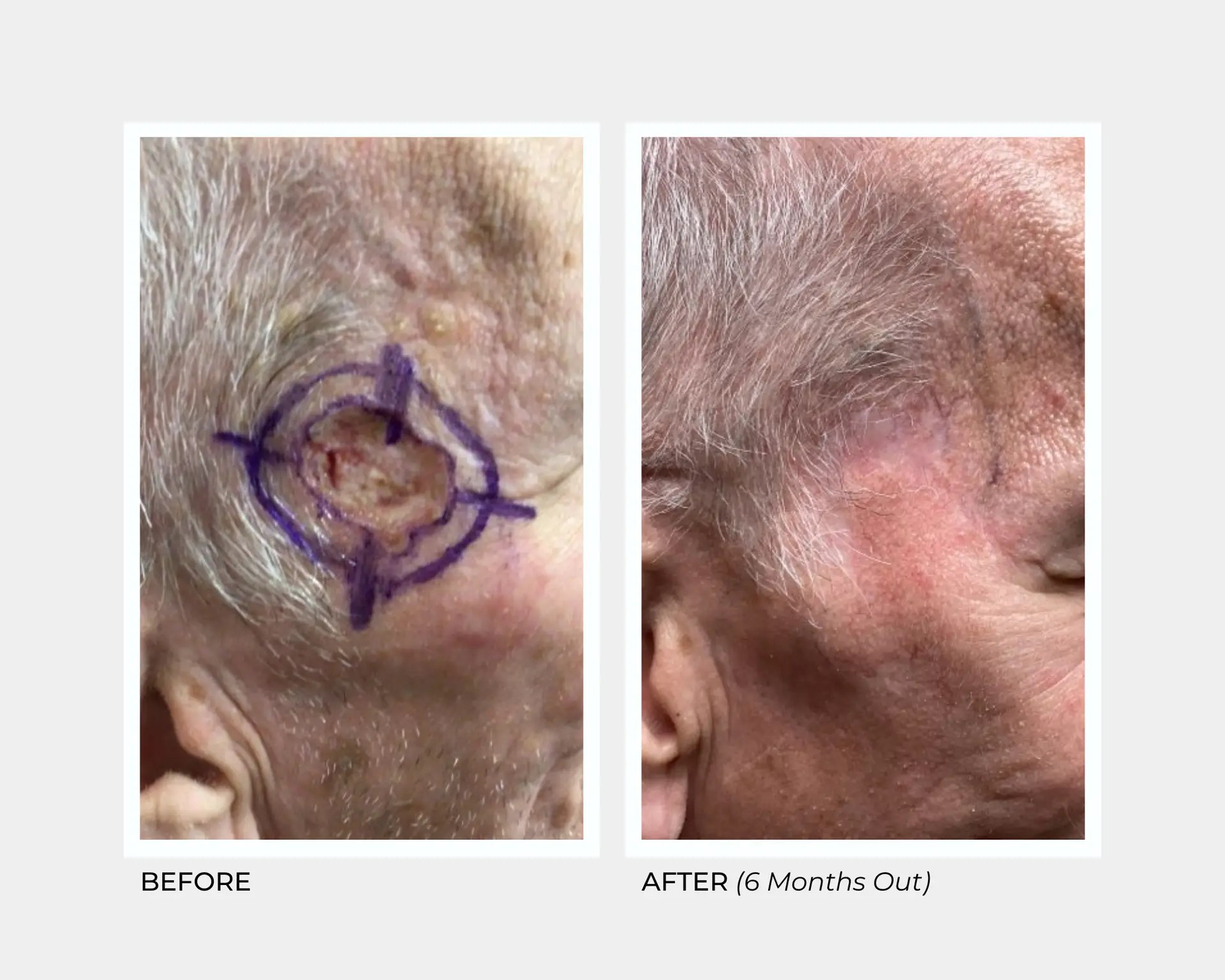 Mohs on the Temple with Reconstruction - Swann Dermatology