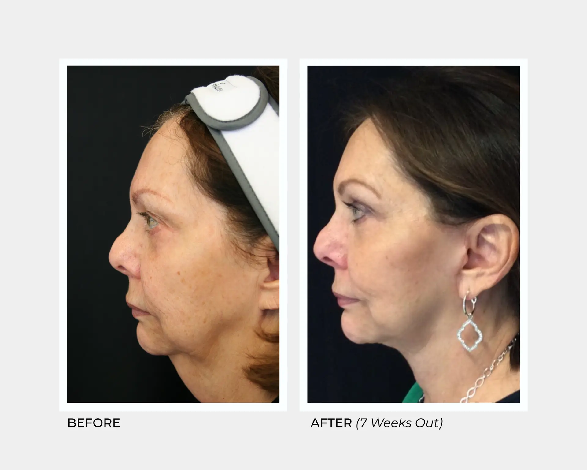 Vertical Vector Face and Neck Lift - Swann Dermatology
