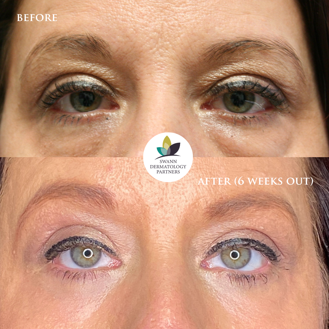 Puffy Eyelid Bags Treatment Blepharoplasty | Springfield MO