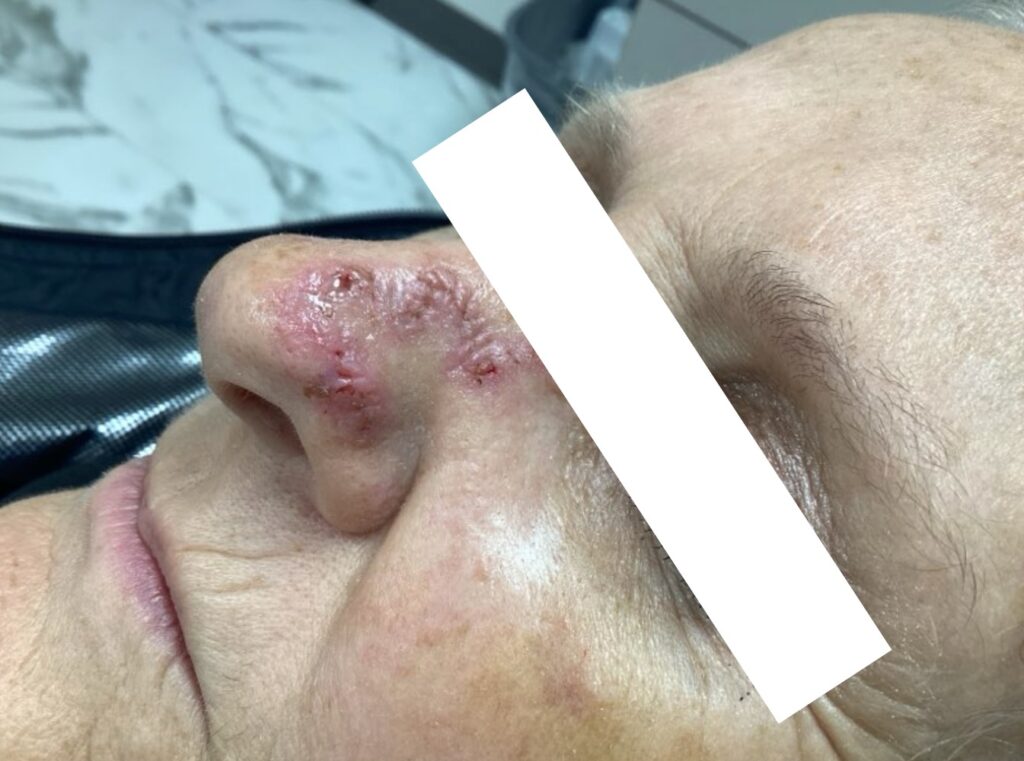 Bilobed Flap Repair - Swann Dermatology Partners