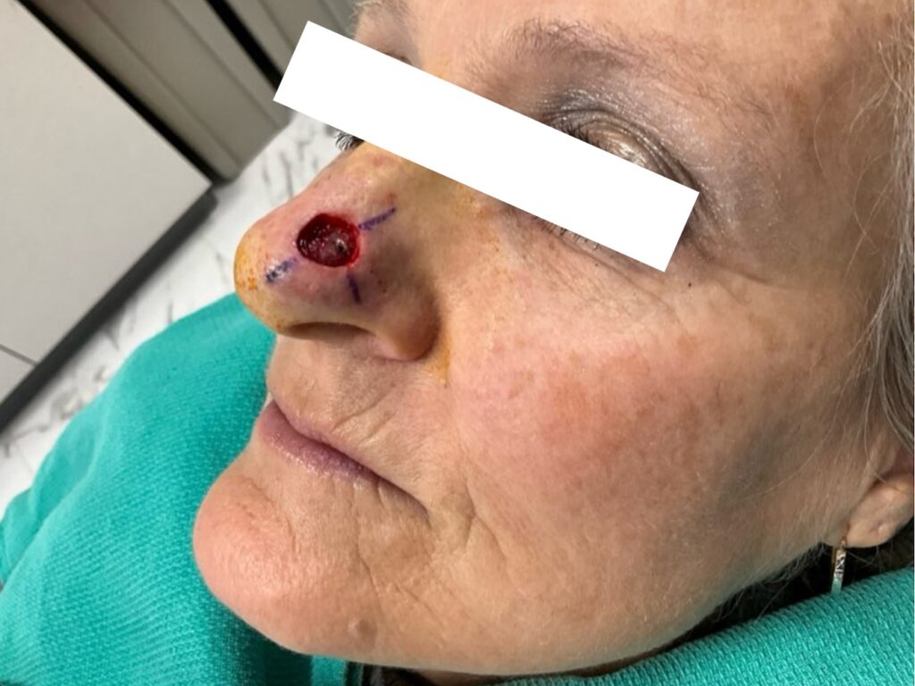 Bilobed Flap Repair - Swann Dermatology Partners