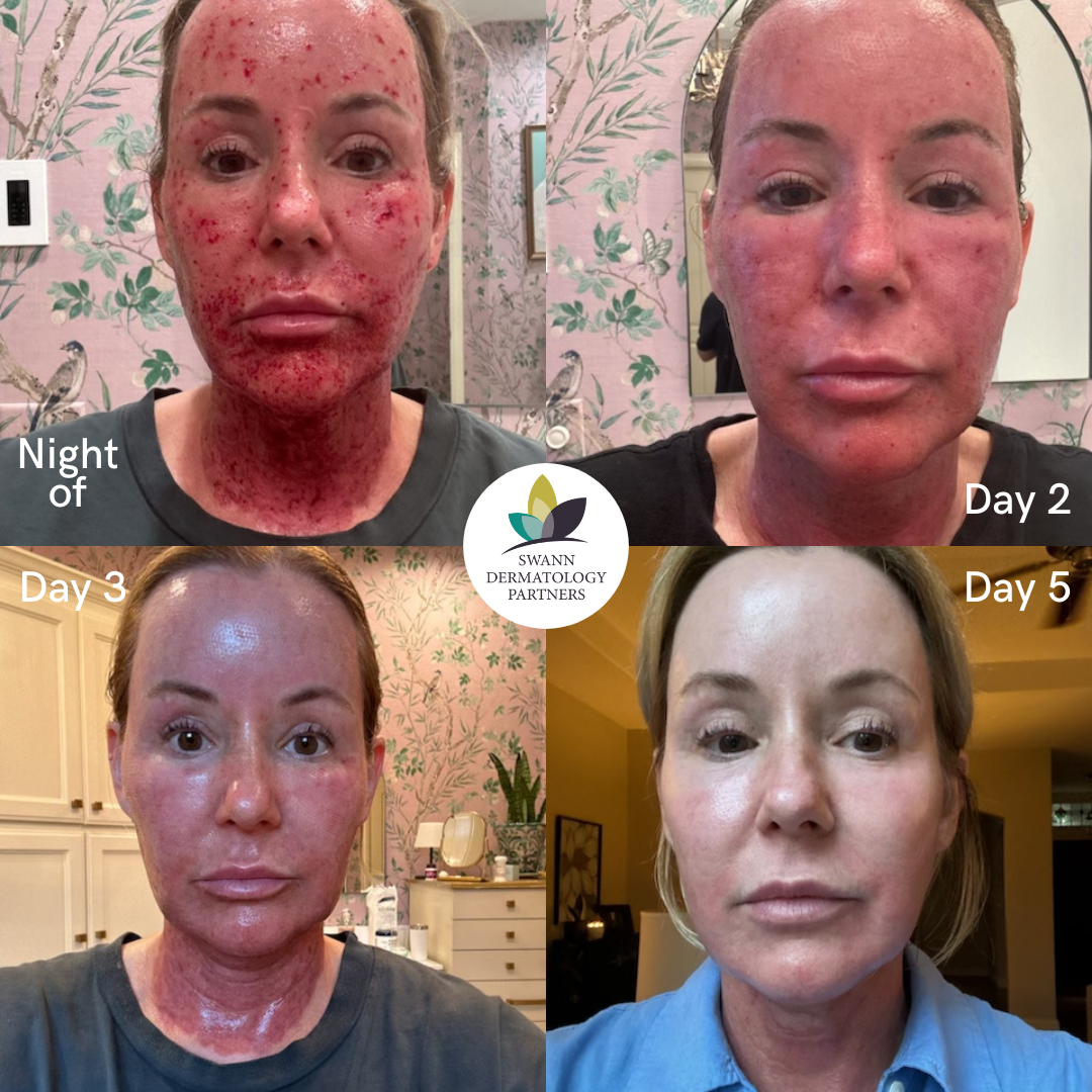 Before and After Photos | Swann Dermatology