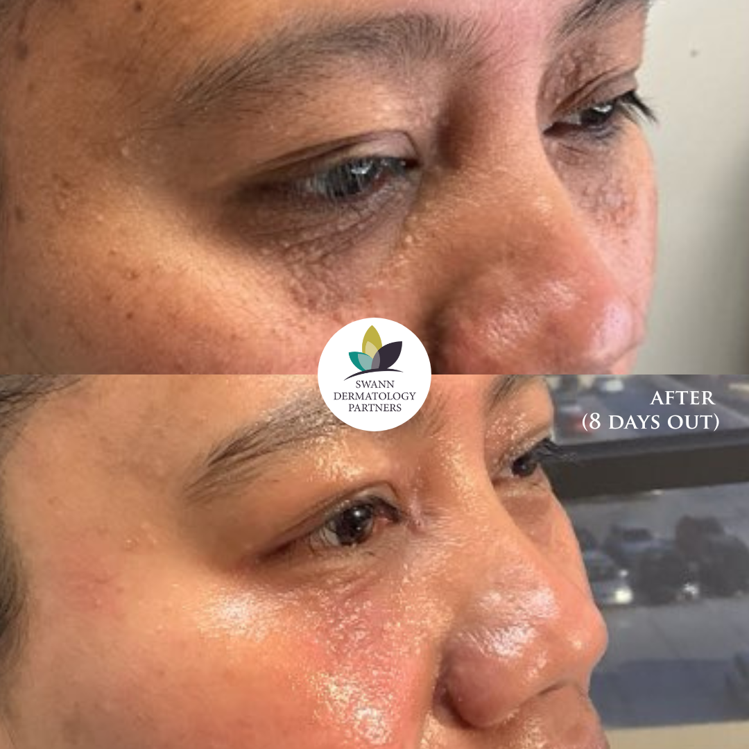 Laser eyelid bumps - Swann Dermatology